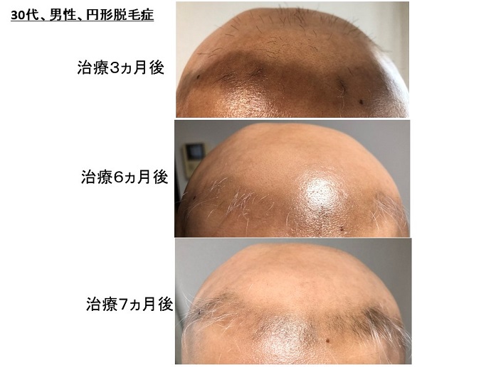 患者様の声：”濃く太い毛が全体に広がってくるのが楽しみです” 患者様からの声・メディア掲載・クリニックからのお知らせ 名古屋kクリニック